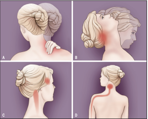 Neck Pain Clinical Practice Guidelines Help Ensure Quality Care ...